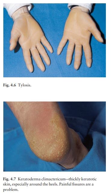 Keratoderma Of The Palms And Soles