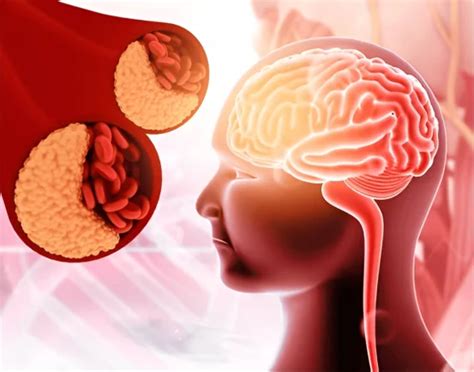 What Is Corpus Callosotomy Surgery Medisuggest