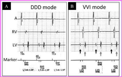 Biventricular Algorithms Crt Programming