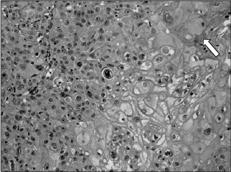 Histopathologic View Of Gingival Squamous Cell Carcinoma Hande ×200