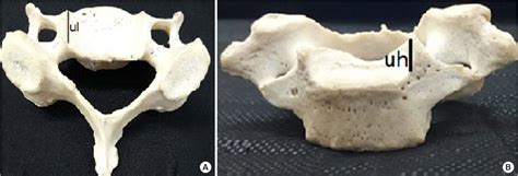 Figure 2 From Morphometry Of The Uncinate Process Vertebral Body And