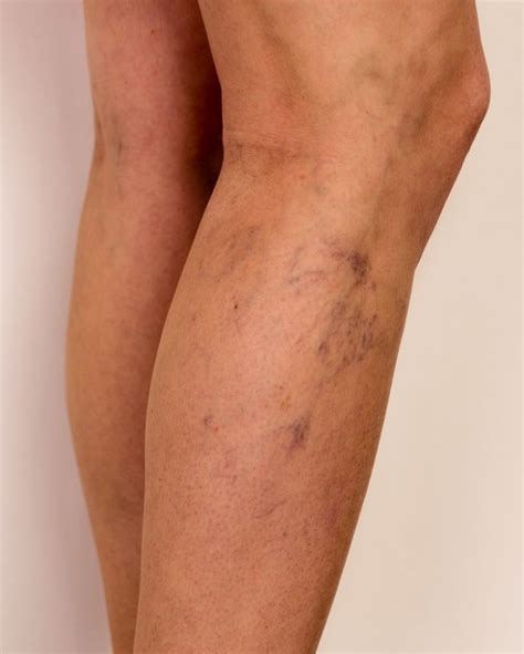 Laser Transdérmico Dra Lara Poltronieri Especialista Em Varizes