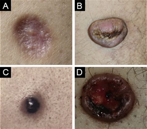 Dermatofibroma Clinicopathological Analysis Of 239 Cases Pmc