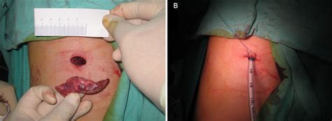 Single Port Thoracoscopic Surgery Can Be A First Line Approach For