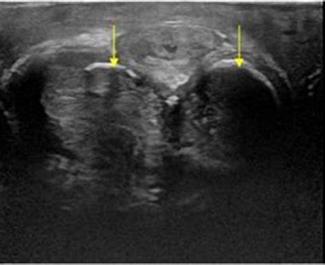 Penile Ultrasound Flashcards Quizlet