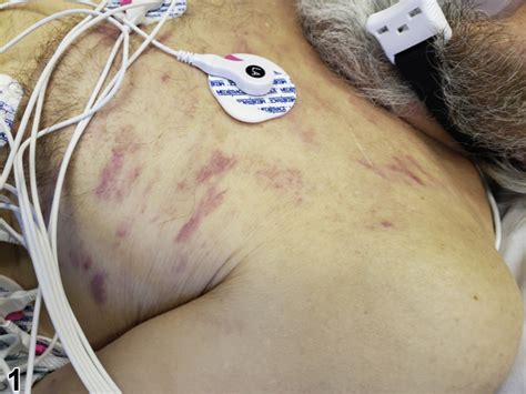 Purpuric Patches And Telangiectasias On The Chest Pmc
