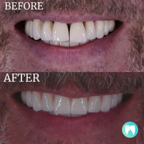 Dental Implants Turkey Full Mouth Packages Results Costs