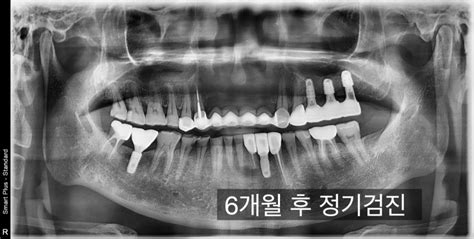 앞니 임플란트 후기 앞니 임플란트 잘 하는 치과 찾는다면 필독사항 네이버 블로그