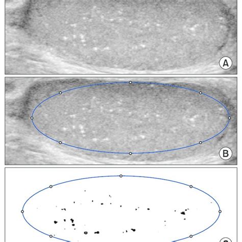 Focal Type A And Diffuse Type B Of Testicular Microlithiasis At Download Scientific