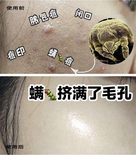 螨虫怎么去除脸上 简单 第3页 大山谷图库