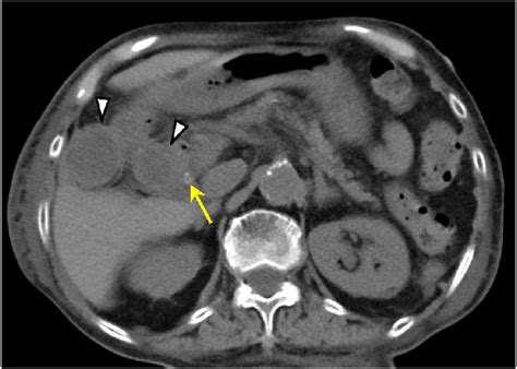 Abdominal Computed Tomography Ct Unenhanced Ct Showing A Distended