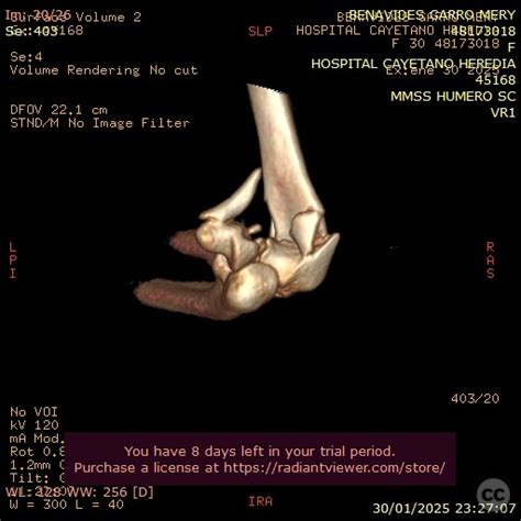 Displaced Intra Articular Distal Humerus Fracture With Olecranon Osteotomy