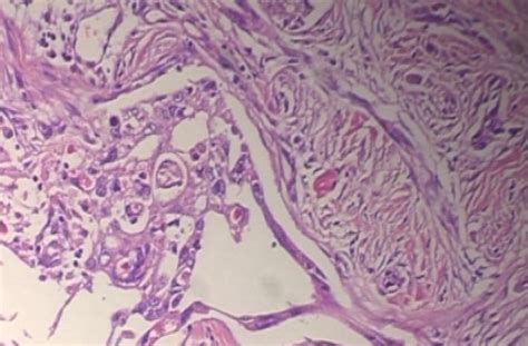 GitHub Avinassh Breast Cancer Prediction