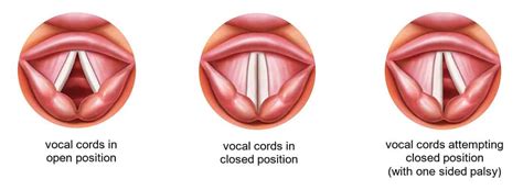 Vocal Cord Dysfunction Vocal Cord Paralysis Voice Box Disorder