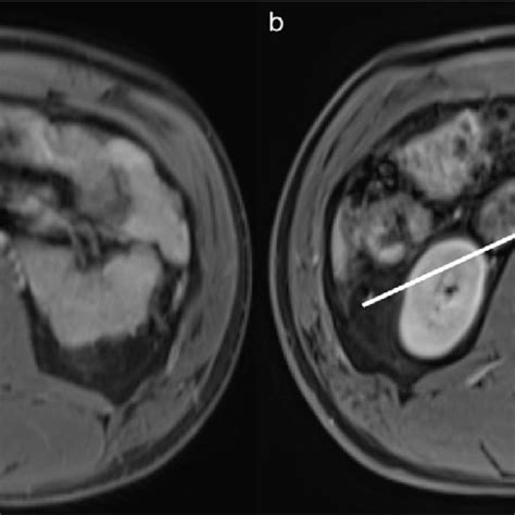 Staging Of A 29 Year Old Male Patient After Surgical Resection Of An Download Scientific