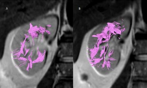 Coronal A Pre And Post Treatment Diffusion Tensor Tractography Images Download Scientific