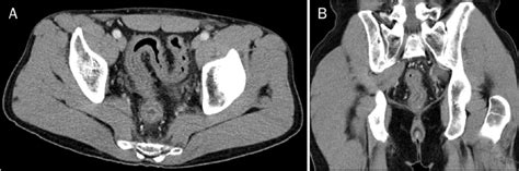 Abdominal Ct Scan Findings Abdominal Ct Showed Diffuse Wall Thickening