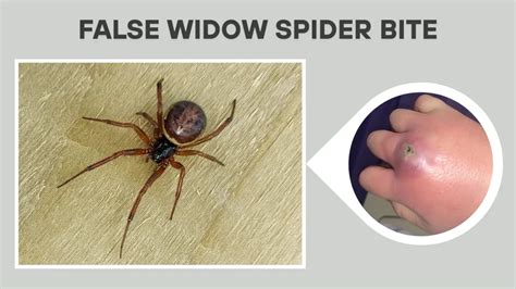 37 Types Of Spider Bites Identification With Pictures Symptoms