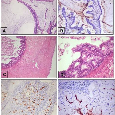 A B Endometrioid Carcinoma With Moderate Apical Membranous Expression