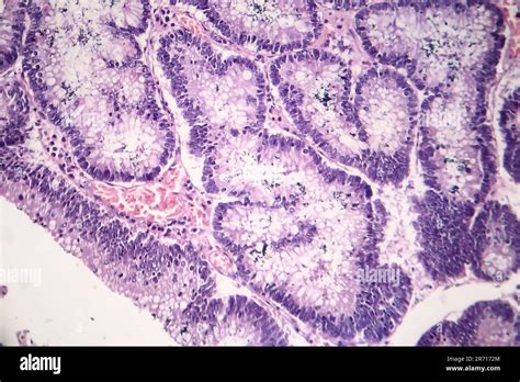 Histopathology Of Intestinal Adenoma Light Micrograph Photo Under