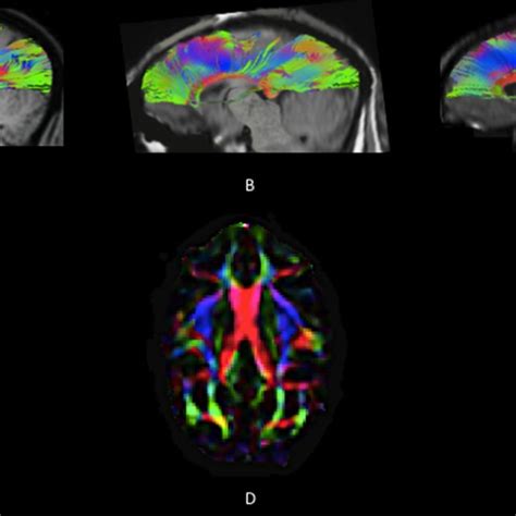 Dti Results For N 3 Subjects Reconstructed Fibers Traversing The Download Scientific Diagram