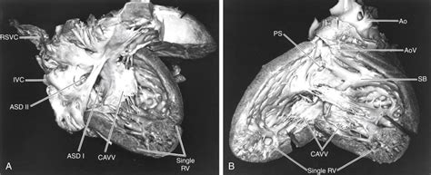 The Heterotaxy Syndromes Asplenia Polysplenia And With Normally