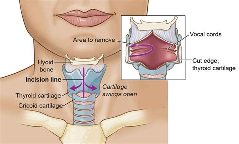 Total Or Partial Laryngectomy Procedure Complications Risks And Recovery