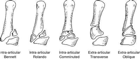 Figure 6 From Fractures Of The Base Of The First Metacarpal Current