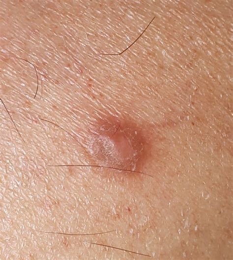 Tratamiento De Dermatofibroma