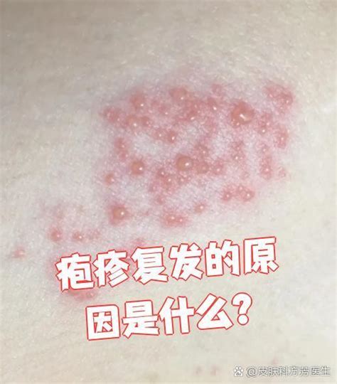 疱疹复发的原因是什么？