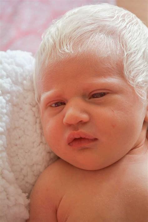 Caucasian Albino