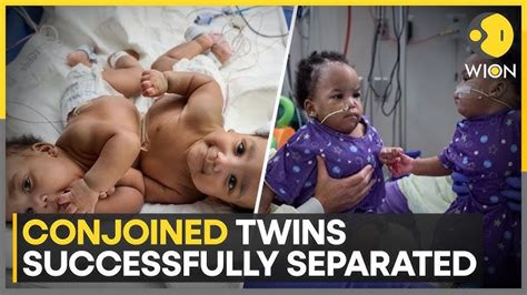 Conjoined Twins Separated Successfully Photos Abandoned Conjoined