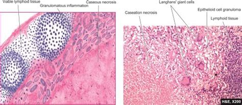 Caseous Necrosis Lymph Node