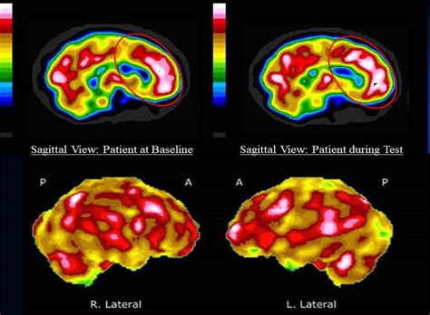 Spect Scan Brain
