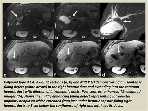 Presentation1 Pptx Radiological Imaging Of Cholangiocarcinoma Pptx