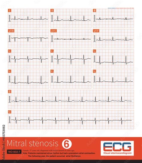 Female 57 Years Old Diagnosed With Mitral Stenosis 6 Years Ago When