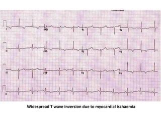 ECG Changes In Myocardial Ischemia And Injury PPTX