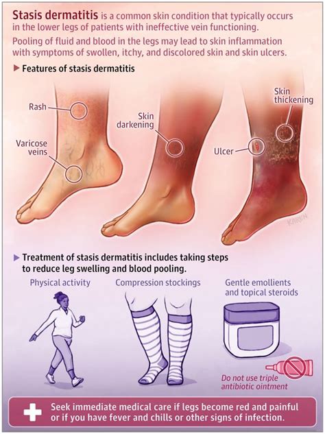 Venous Insufficiency Venous Stasis Venous Swelling Artofit