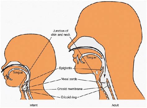 Airway Management Anesthesia Key