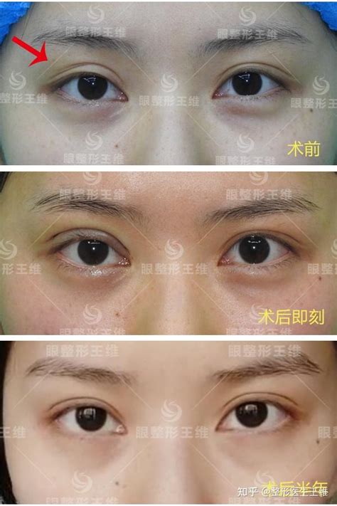 双眼皮术后出现三眼皮高位粘连怎么办修复会复发吗 知乎