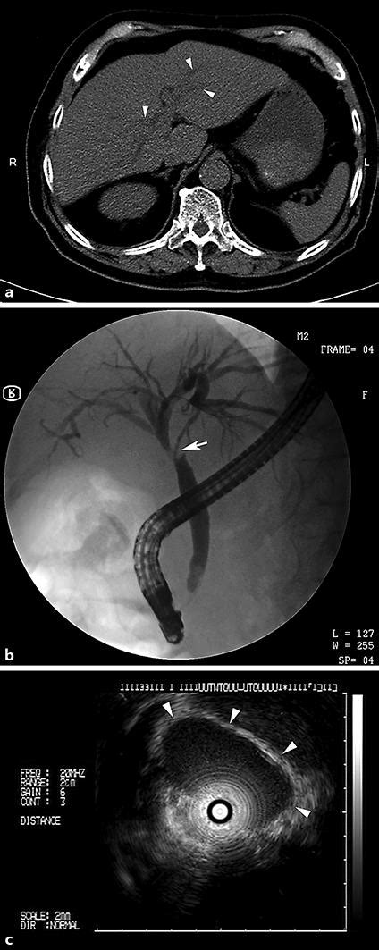 A Non Enhanced Abdominal Computed Tomographic Scan Showing Bilateral Download Scientific