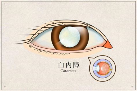 白内障患者如何选择一款适合自己的人工晶体？ 知乎