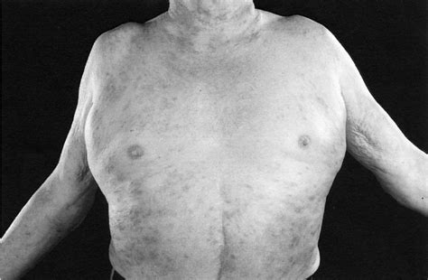 Widespread Erythematous Maculopapular Skin Rash Download Scientific Diagram