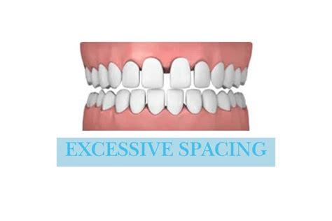 How Do You Fix Excessive Spacing In Teeth