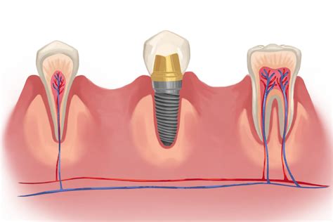 Good Candidates For Dental Implants Hermitage Tn