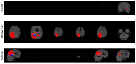 Brats 20 Dataset Labels Visualization On 3d Images · Issue 5682 · Project Monaimonai · Github