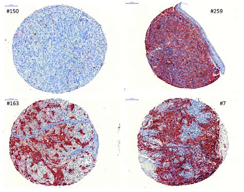 Representative Immunohistochemical Analysis Of Hla Class Ii Antigens On Download Scientific