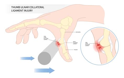 Metacarpophalangeal Joint Thumb