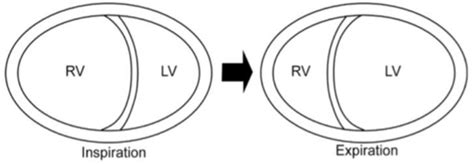 What Is Ventricular Interdependence Medicine Specifics