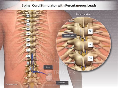 Spinal Cord Stimulator With Percutaneous Leads Trialquest Inc